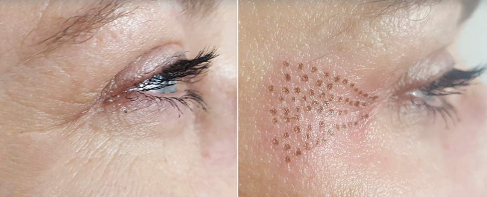 What Is Plasma Fibroblast Therapy?